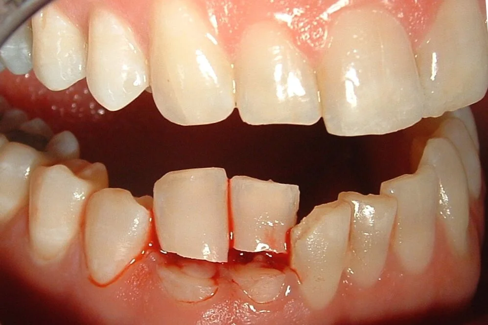 Crowns in Sidcup | Cosmetic Dentist | Birkbeck Dentistry