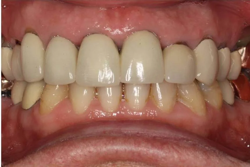 Crowns in Sidcup | Cosmetic Dentist | Birkbeck Dentistry