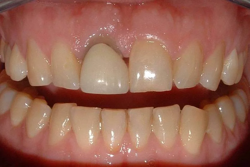 Crowns in Sidcup | Cosmetic Dentist | Birkbeck Dentistry