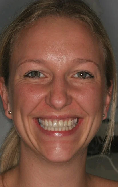 Dental Implants in Sidcup | Cosmetic Dentist | Birkbeck Dentistry